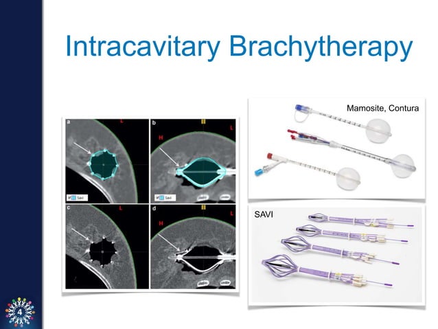 Breast HDR interstitial brachytherapy | PPT | Cancer | Diseases and ...