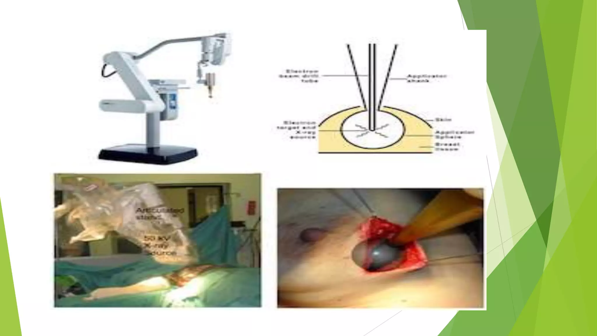 intrabeam intraoperative radiotherapy | PPTX
