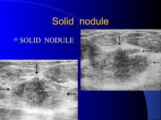 Breast lecture | PPT