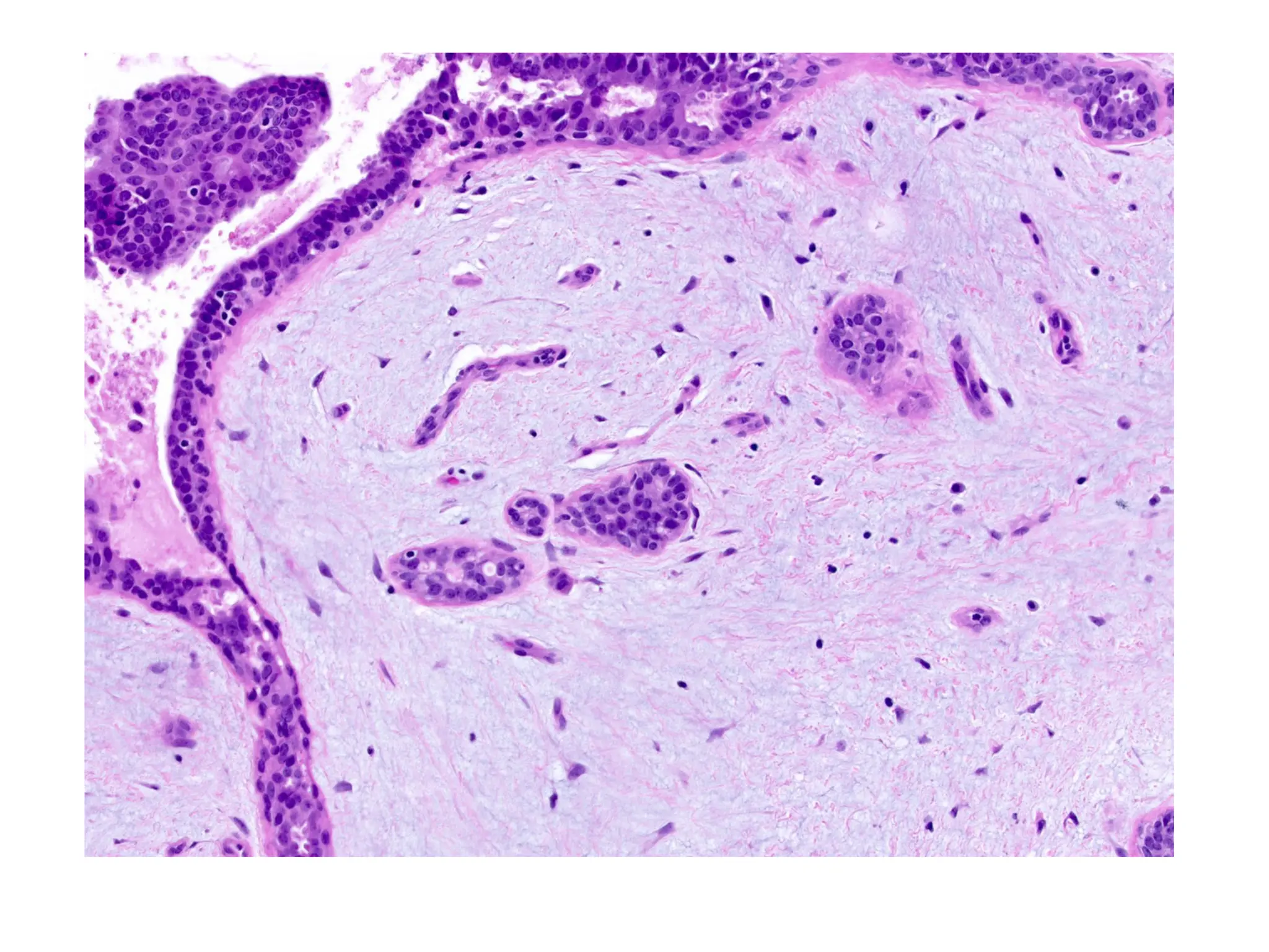 Benign breast diseases Pathology robbins | PPTX