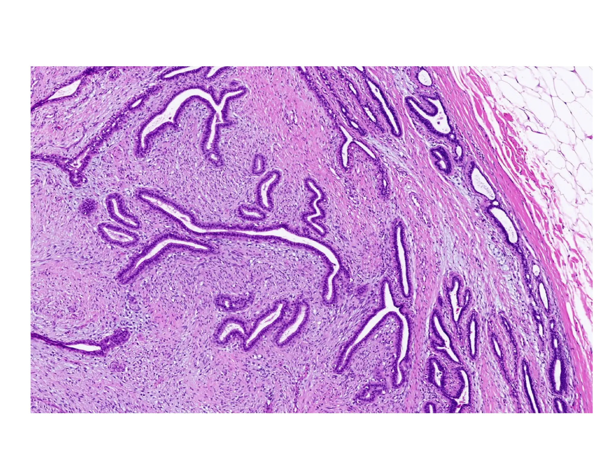 Benign breast diseases Pathology robbins | PPTX