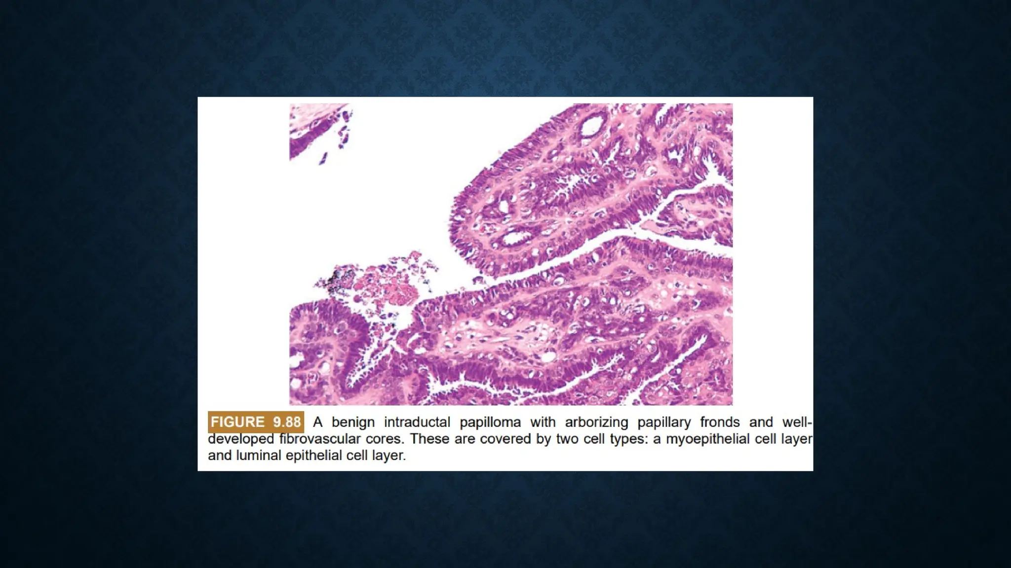 breast lesions and their histo pathology.pptx