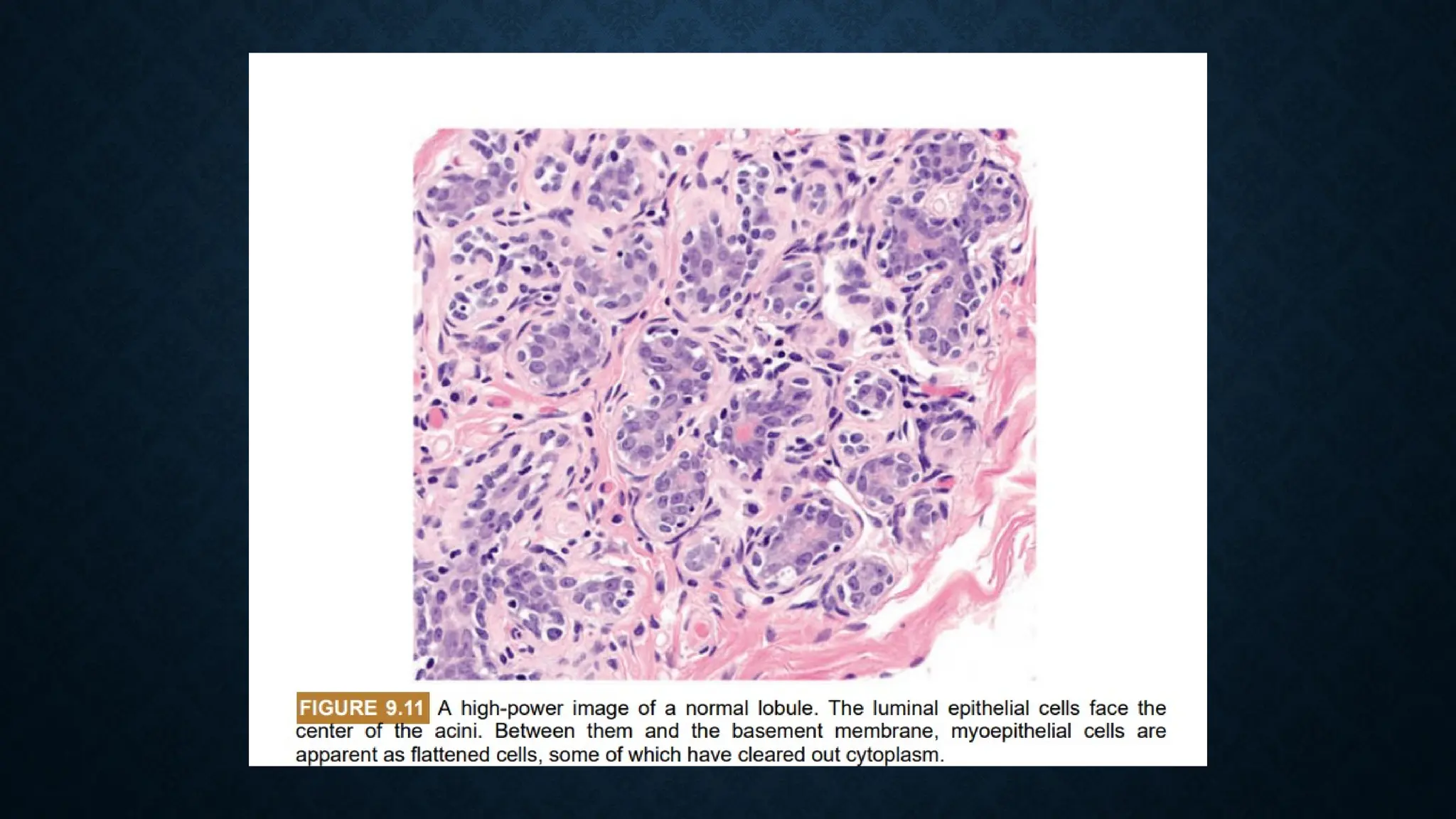 breast lesions and their histo pathology.pptx