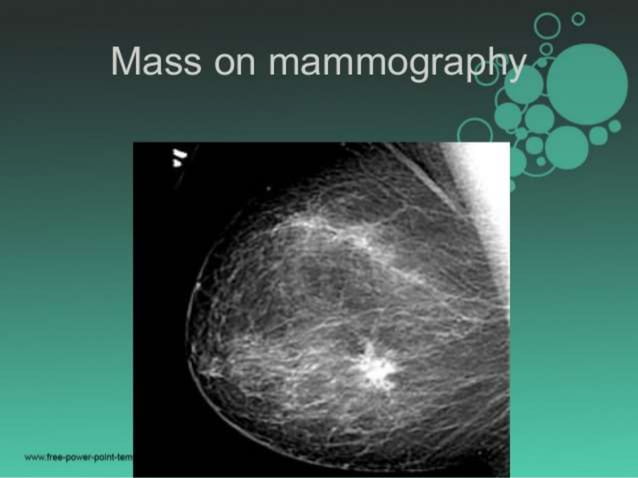 Breast mammography | PPT
