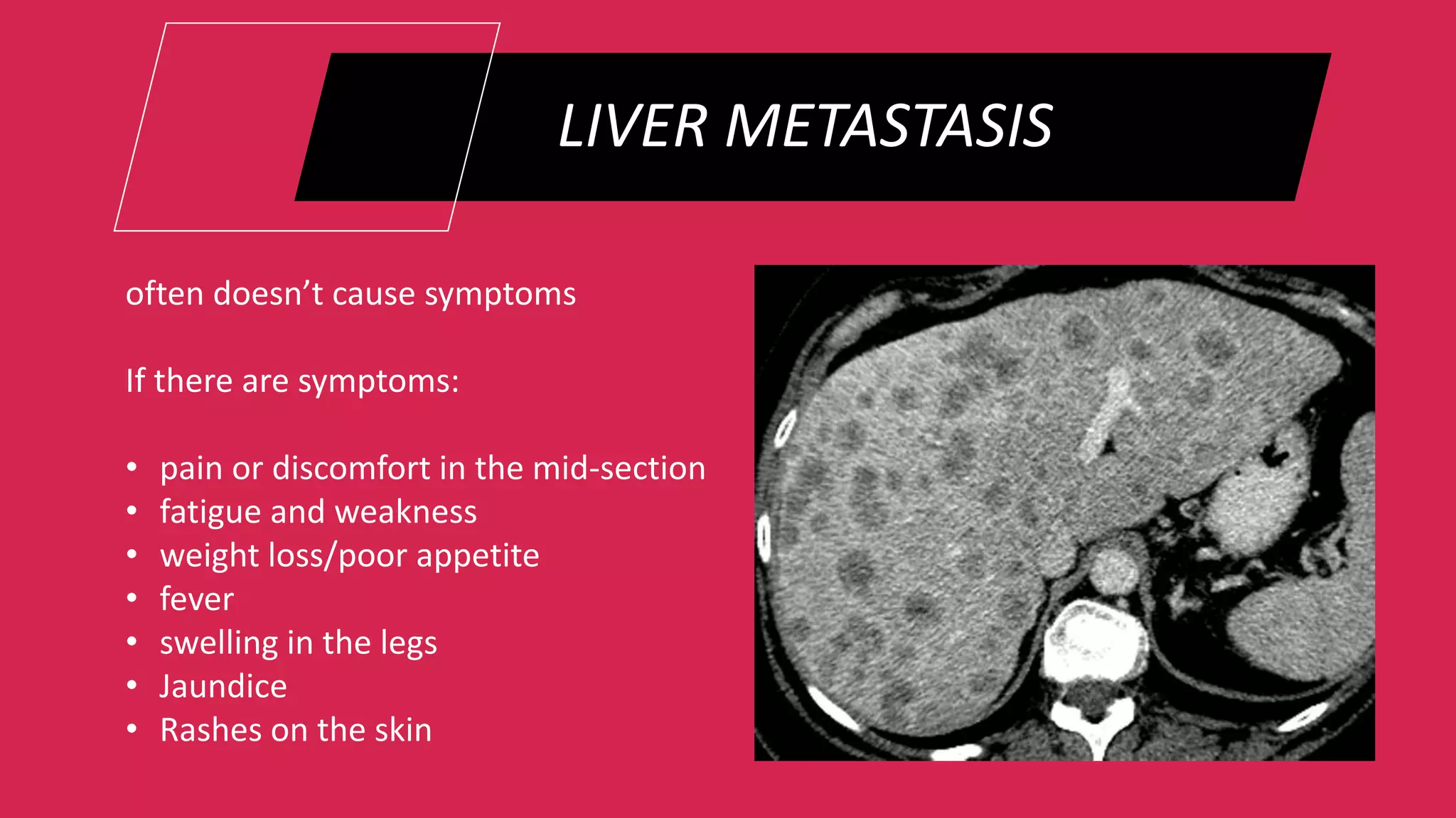 Breast metastase | PPTX