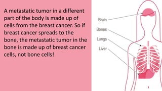 Breast metastase | PPTX