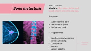 Breast metastase | PPTX