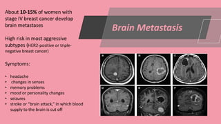 Breast metastase | PPTX