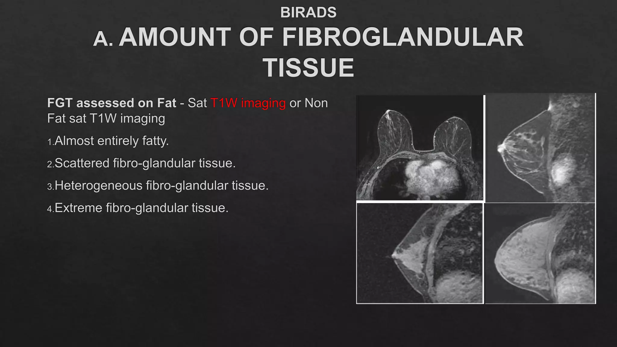 Breast MRI (BIRADS 5th edition 2013) | PDF