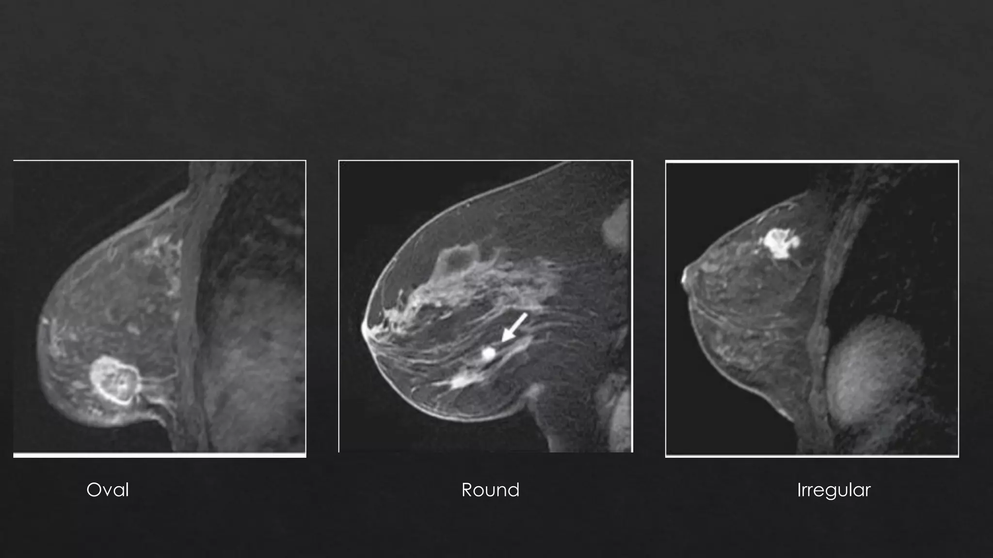 Breast MRI (BIRADS 5th edition 2013) | PDF