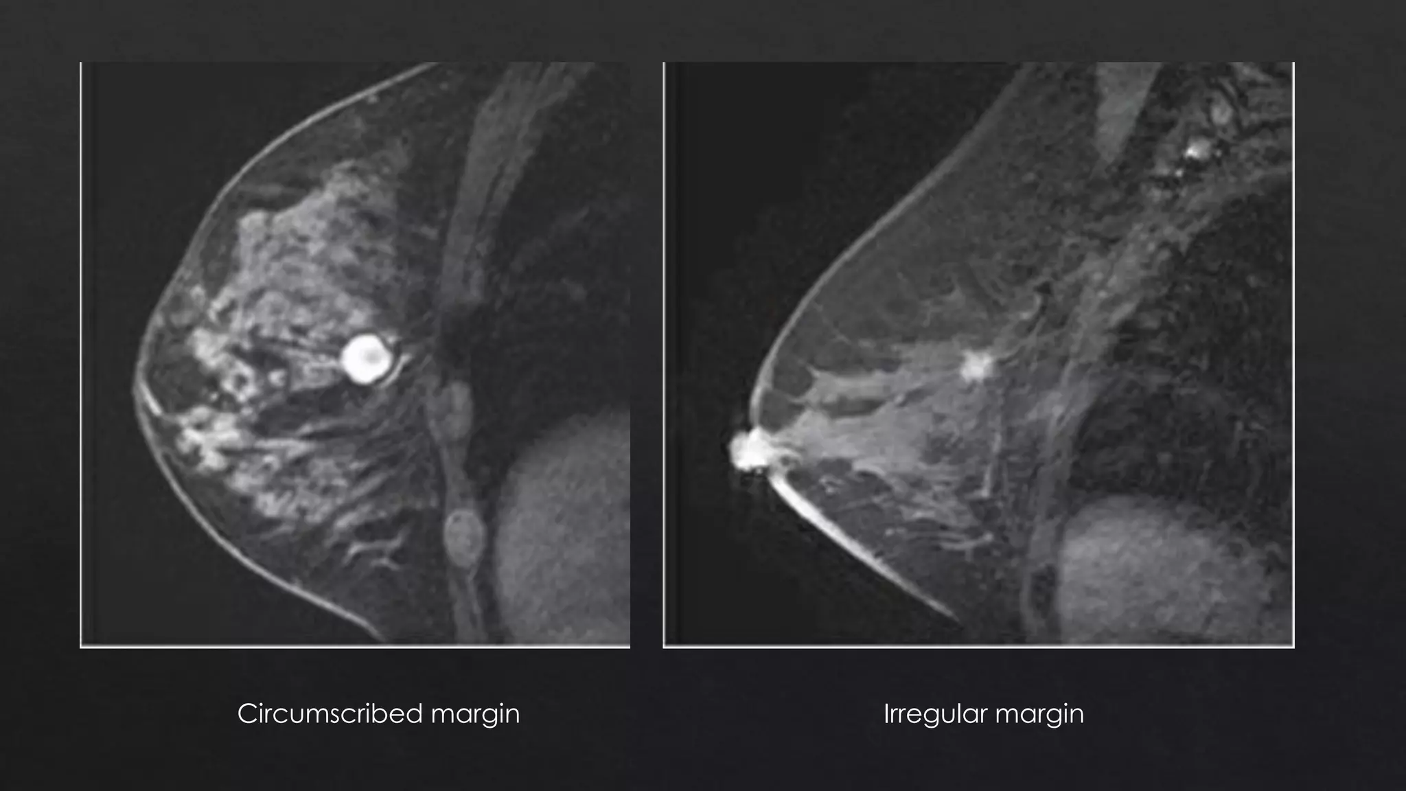 Breast MRI (BIRADS 5th edition 2013) | PDF