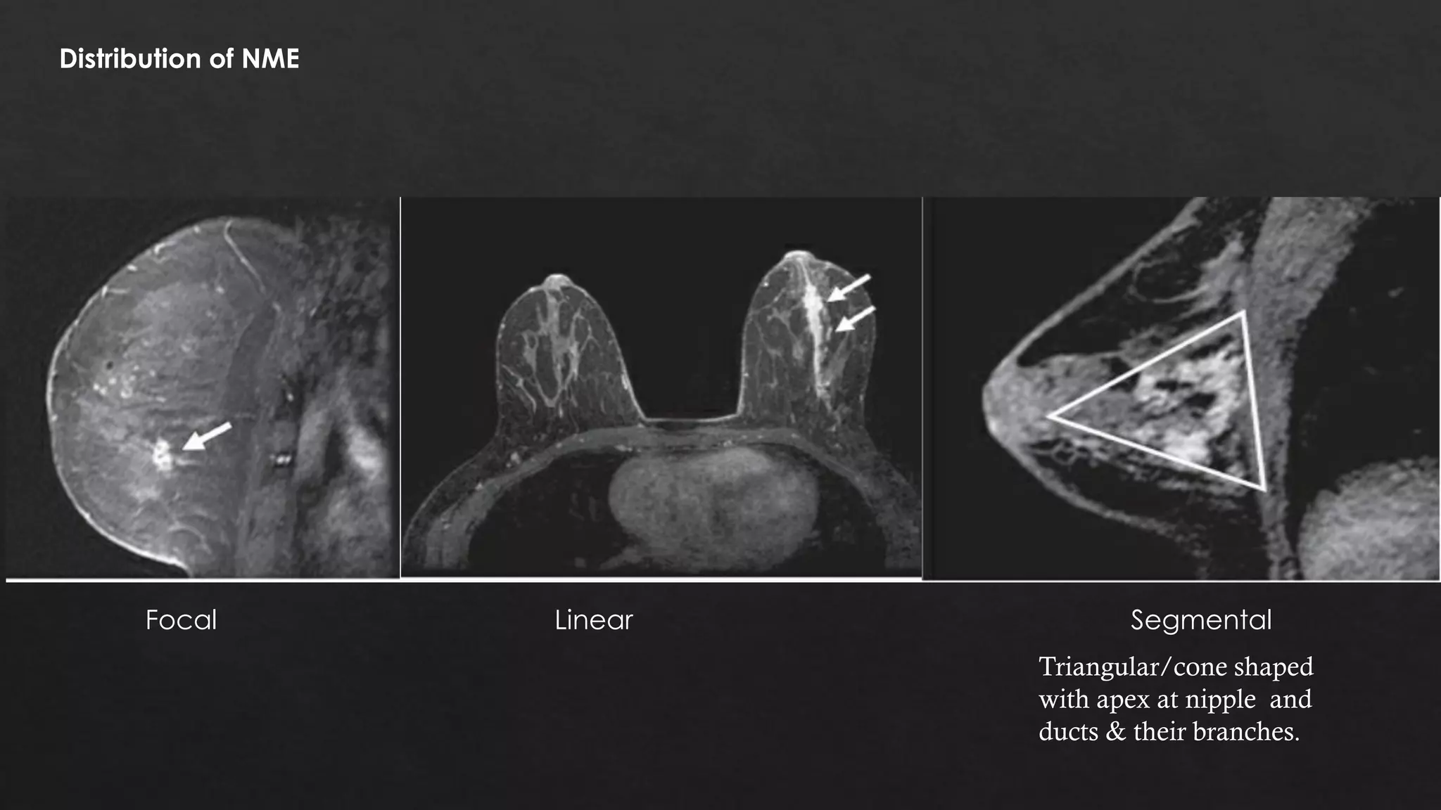Breast MRI (BIRADS 5th edition 2013) | PDF