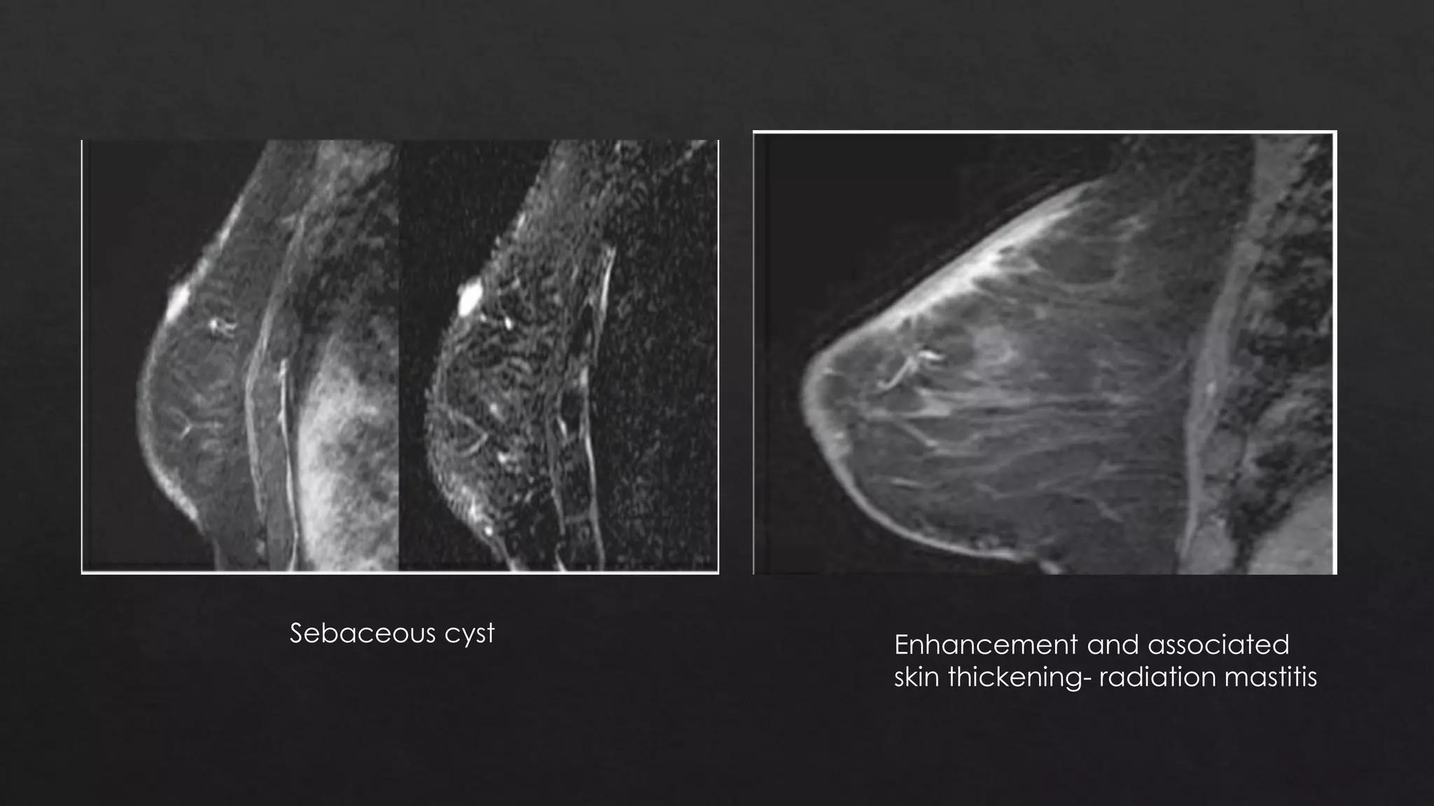 Breast MRI (BIRADS 5th edition 2013) | PDF