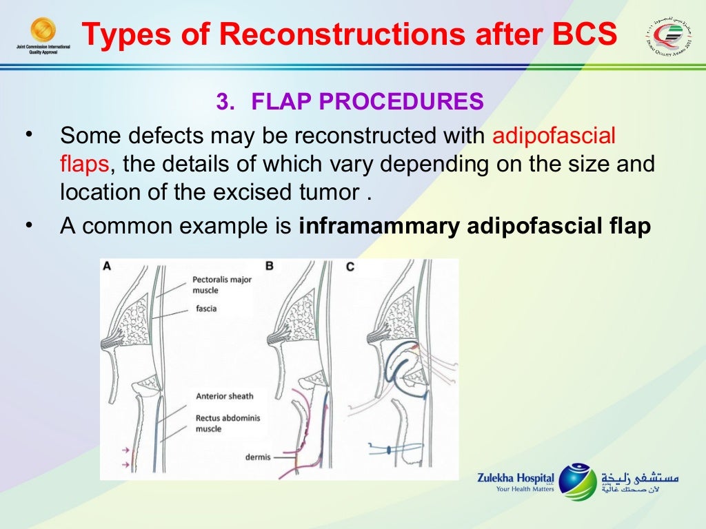 Breast oncoplastic surgery