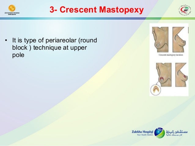 Breast oncoplastic surgery