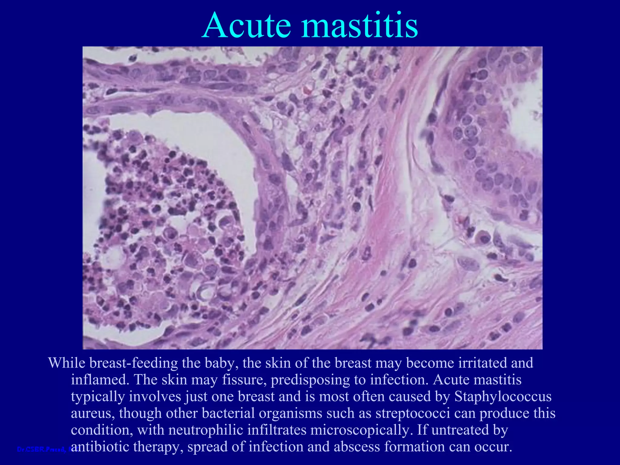 Breast pathology 1 | PDF