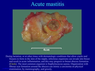 Breast pathology 1 | PPT