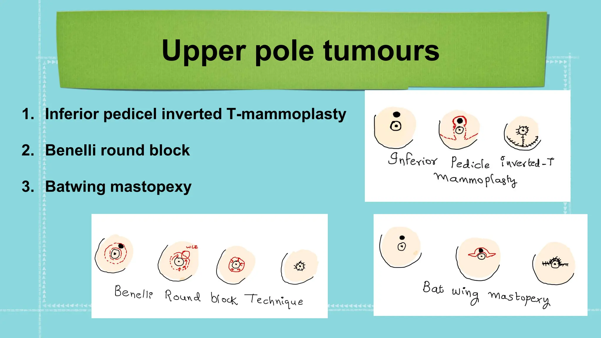 Breast reconstruction surgeries . PPT | PPTX