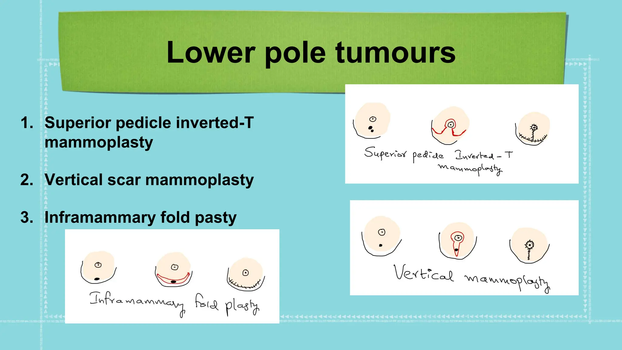 Breast reconstruction surgeries . PPT | PPTX
