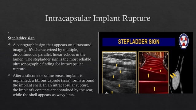 BREAST RECONSTRUCTION USING IMPLANTS.pptx