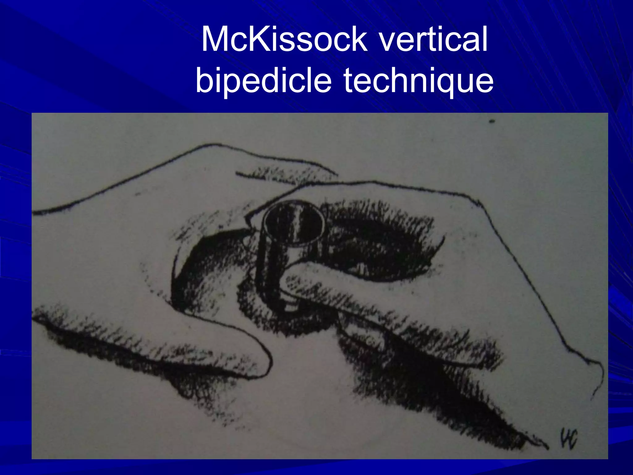 breast reduction ppt.ppt