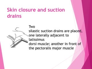 Surgical management of carcinoma breast and breast reconstruction ...
