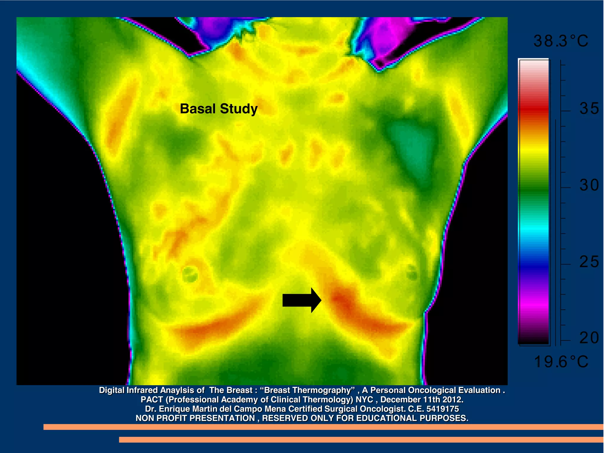 Breast Thermography /Digital Infrared Analysis of the Breast | PPT