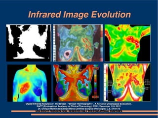 Breast Thermography /Digital Infrared Analysis of the Breast | PDF