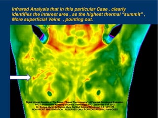 Breast Thermography /Digital Infrared Analysis of the Breast | PDF