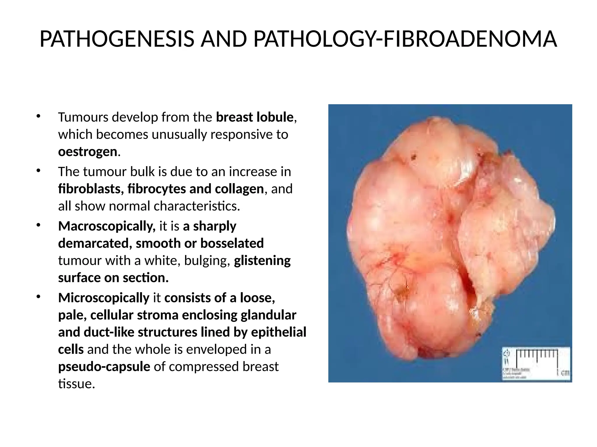 Breast_Tumours5367475377359276t2r24682466 | PPTX