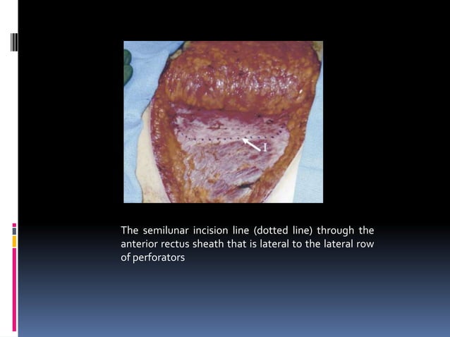 DIEP Flap - For Breast Reconstruction