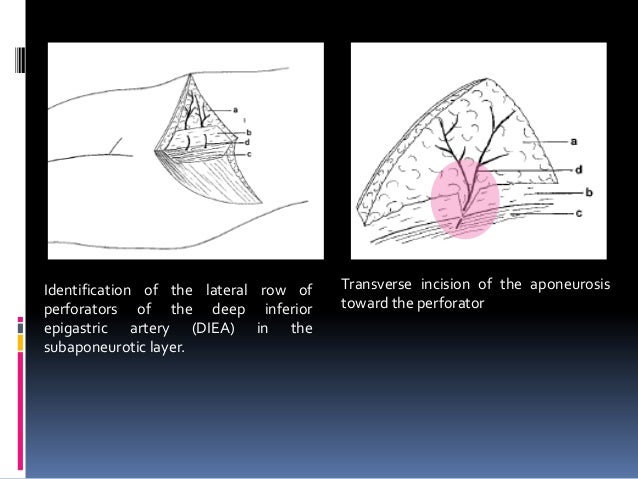 DIEP Flap - For Breast Reconstruction