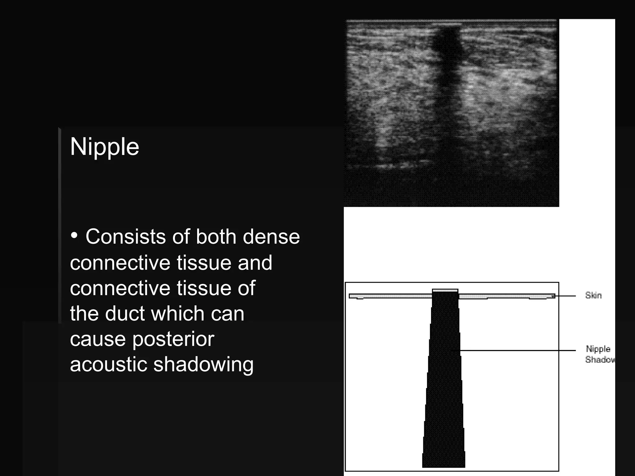 Breast ultrasound | PPT | Cancer | Diseases and Conditions
