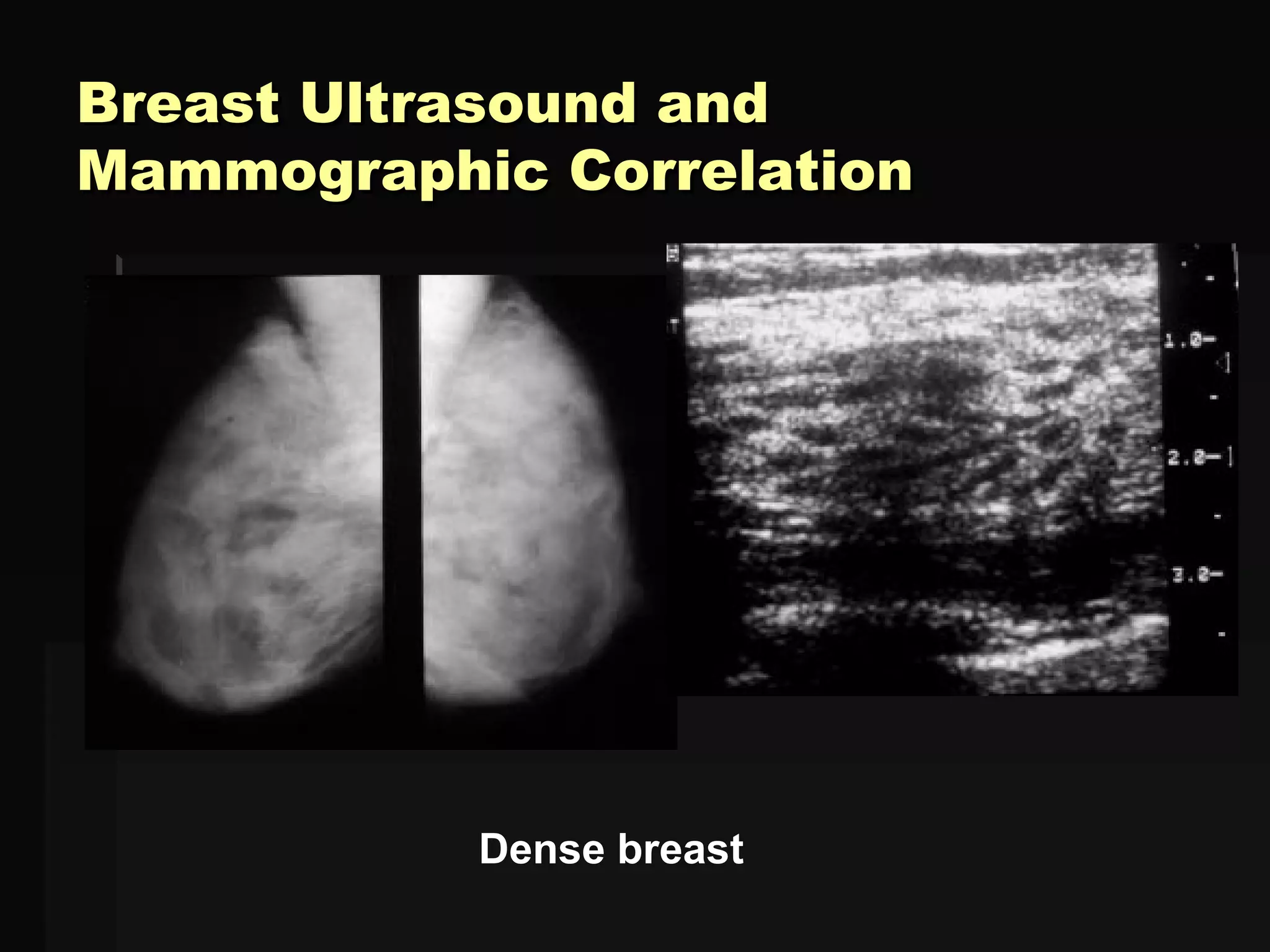 Breast ultrasound | PPT