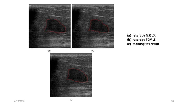 Breast ultrasound image segmentation | PPTX | Geography | Science