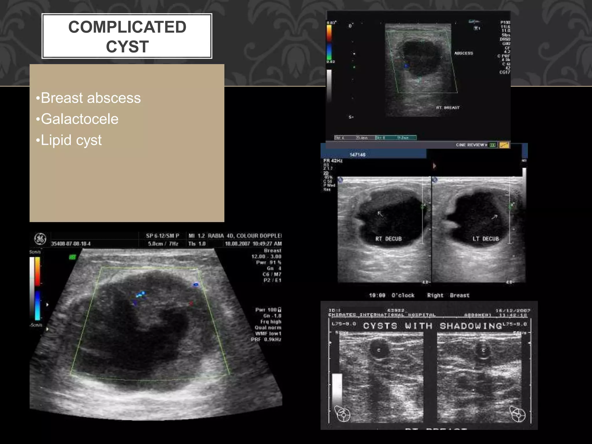 Breast ultrasound techniques | PPTX