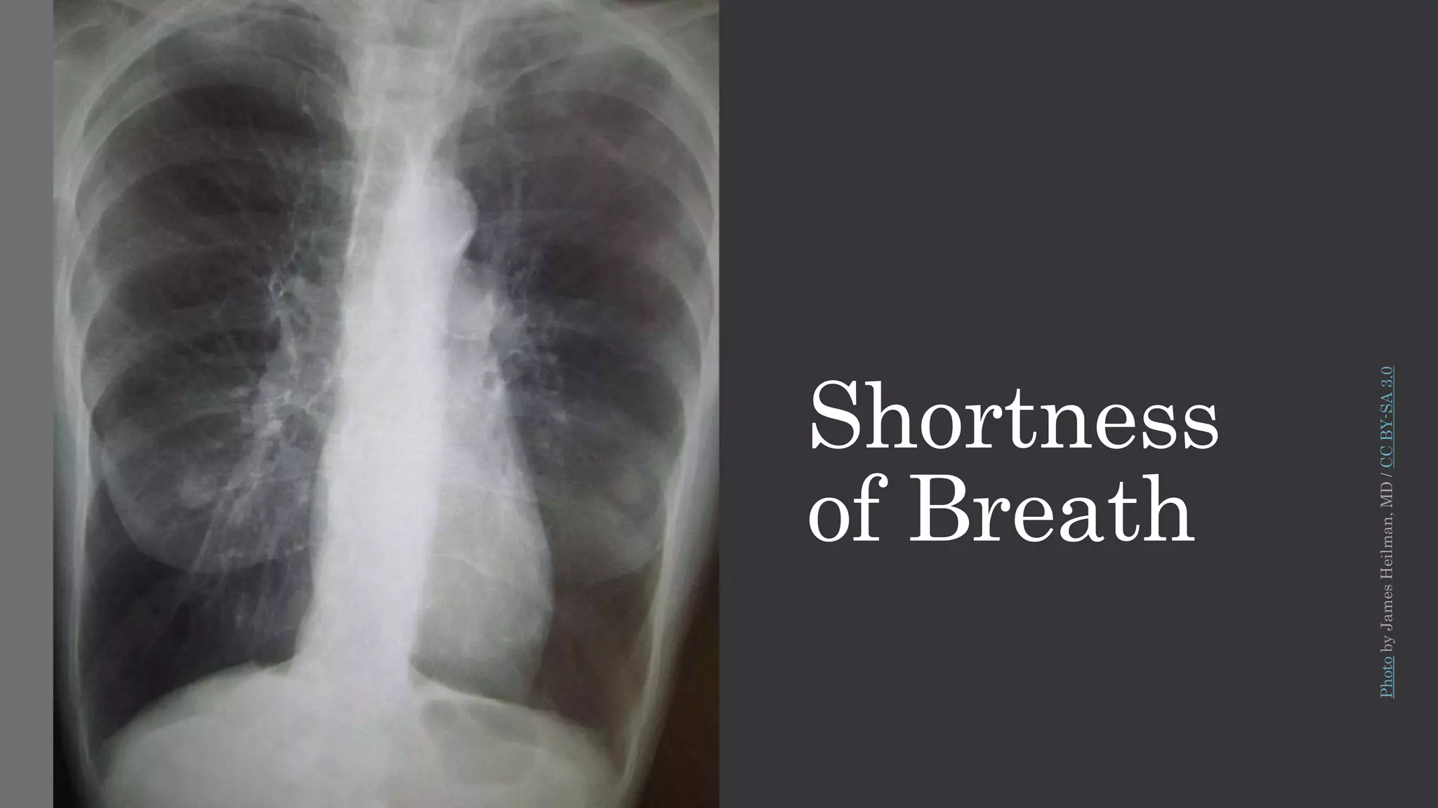 Breathlessness | PPTX