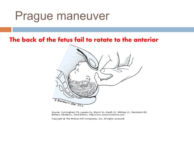 Breech presentation | PPTX | Pregnancy | Reproductive Health