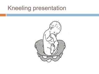 Knee Breech Presentation