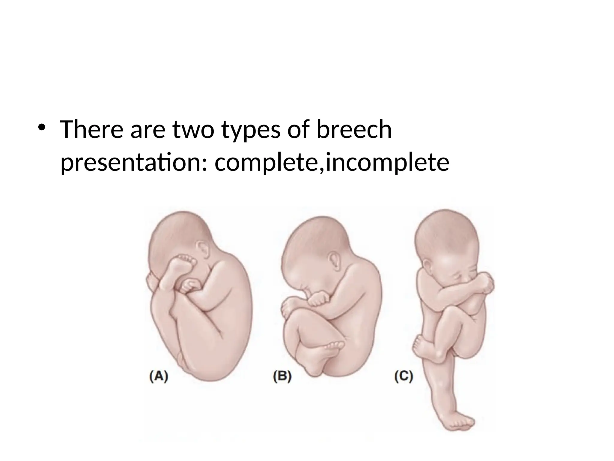 Breech presentation, types and its management | PPTX