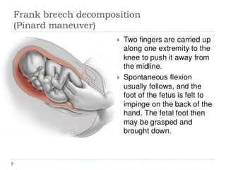 Breech presentation, types and its management | PPTX