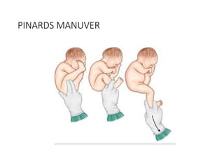 Breech presentation, types and its management | PPTX