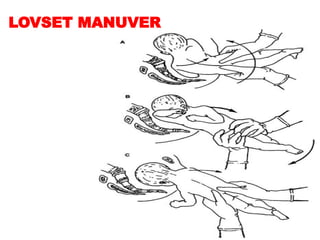 Breech presentation, types and its management | PPTX