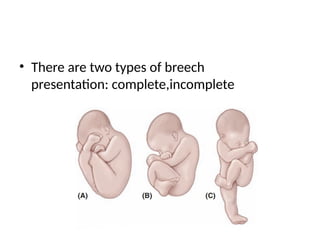 Breech presentation, types and its management | PPTX