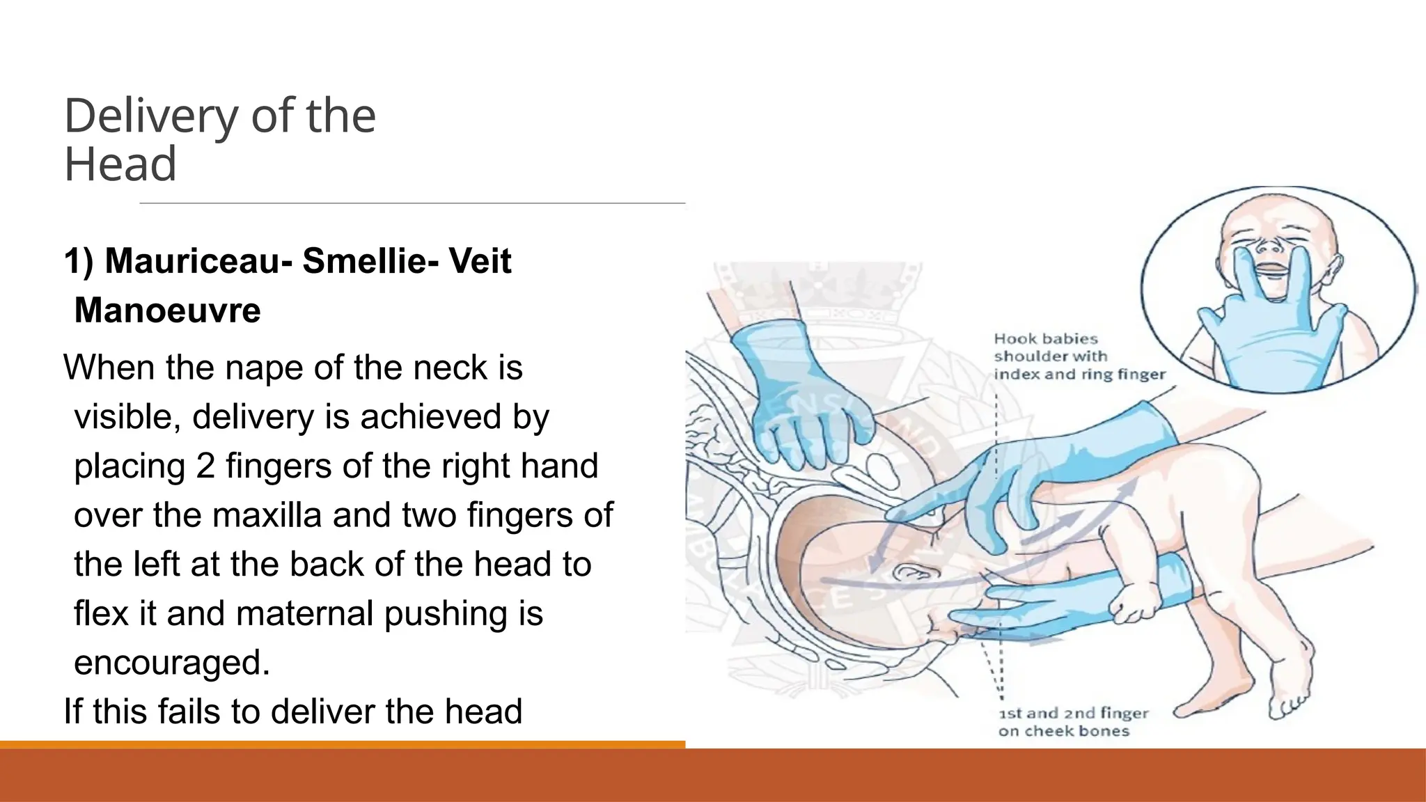 Breech presentation, types, manuvers, definition , diagnosis | PPTX