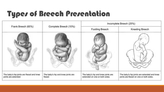 Breech presentation, types, manuvers, definition , diagnosis | PPTX