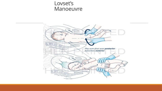 Breech presentation, types, manuvers, definition , diagnosis | PPT