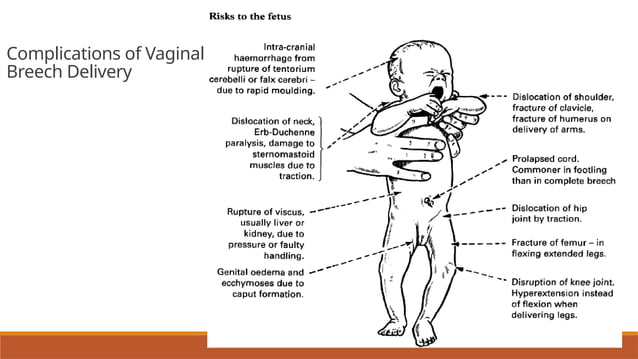 Breech presentation, types, manuvers, definition , diagnosis | PPT