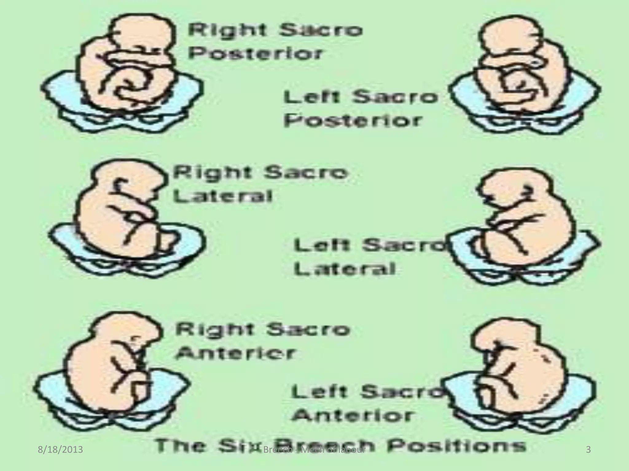 Breech mech of labour | PPTX