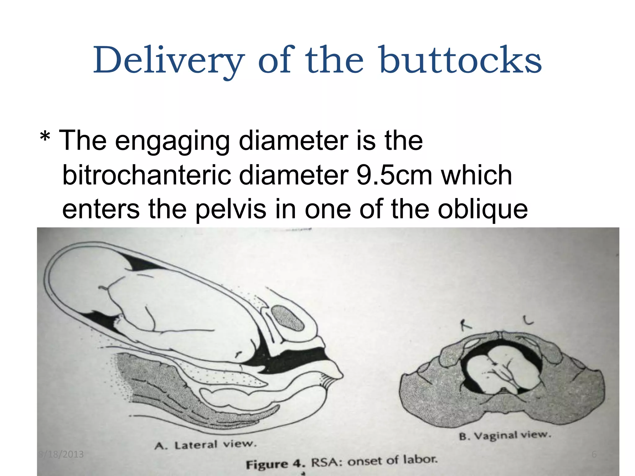 Breech mech of labour | PPTX